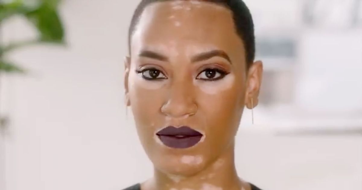 Meet Covergirl’s First Model With Vitiligo, Amy Deanna