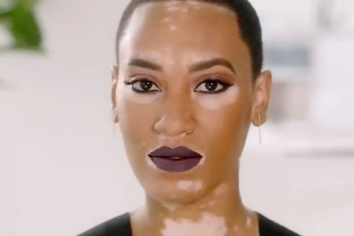 Top 10 Models With Vitiligo Breaking Beauty Standards - All My Friends Are Models