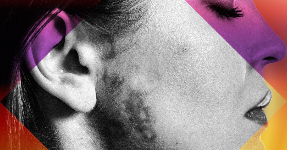 A Laser Expert Shares Solutions for Facial Birthmarks