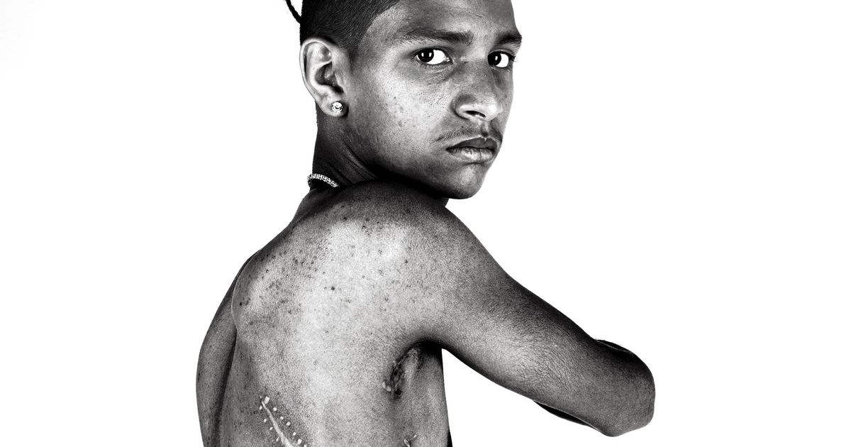 School-Shooting Survivors Bare Their Scars and Bear Witness