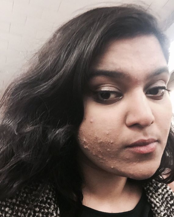 Iva Dixit on Accutane Acne And Her Routine