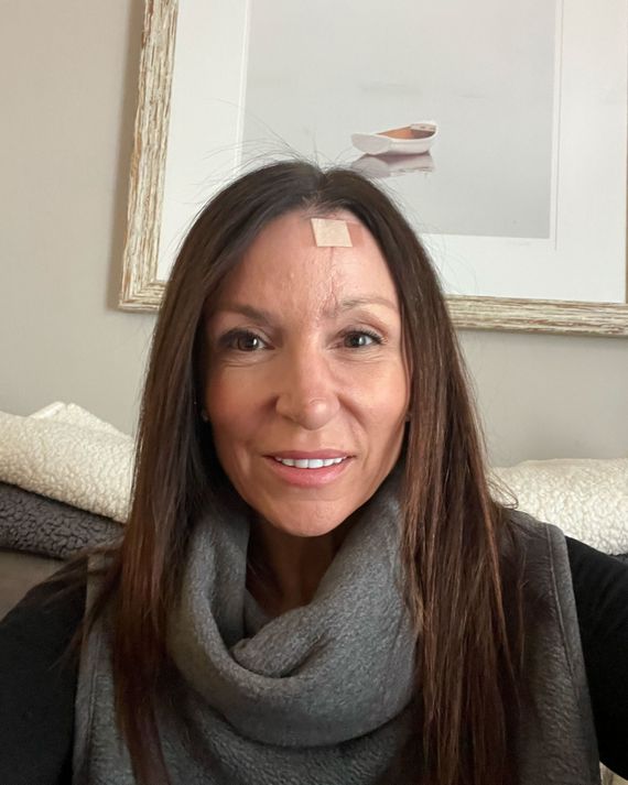 My Journey After Losing My Nose to a Dog Bite