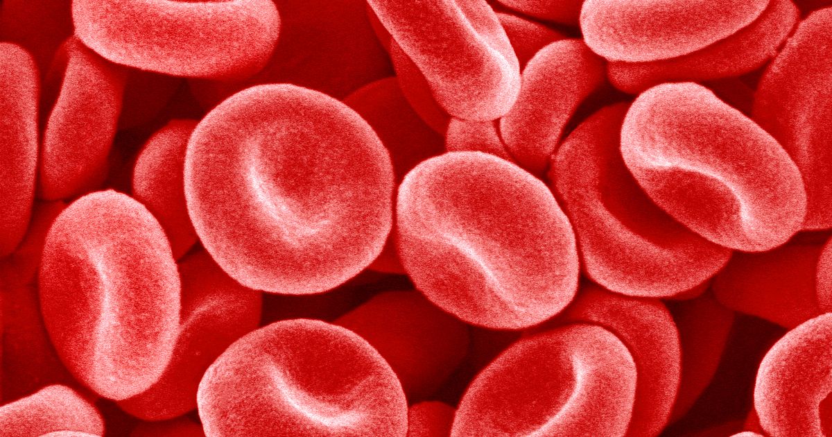 Everything to Know About Iron Deficiency: Symptoms & More