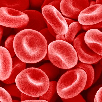 Everything to Know About Iron Deficiency: Symptoms & More