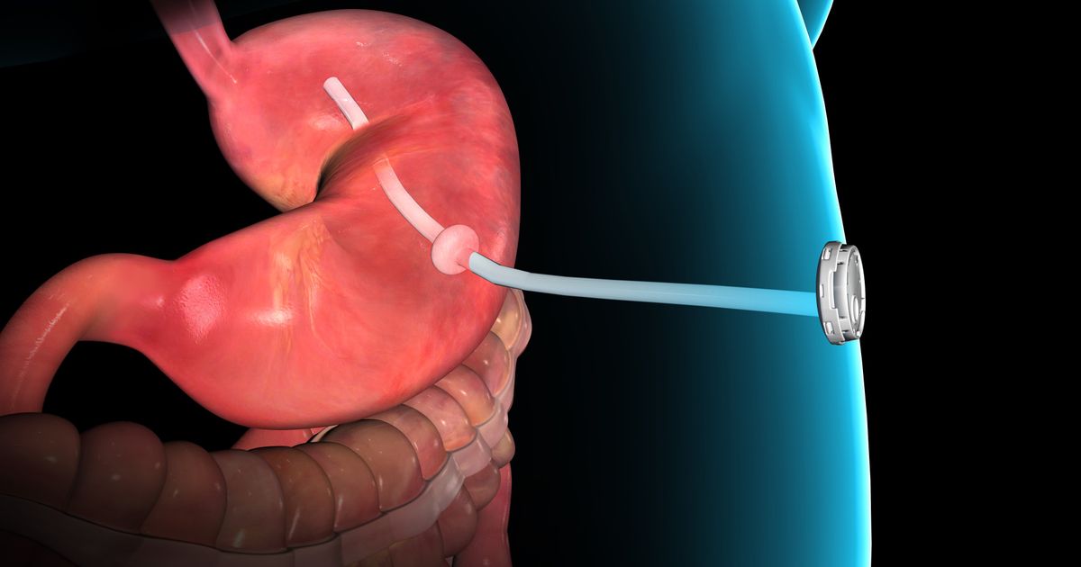 This Obesity Pump Actually Sucks Food Out of Your Stomach
