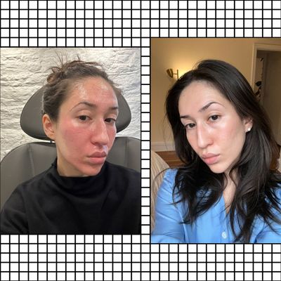 Exosomes Skin Treatment: Review