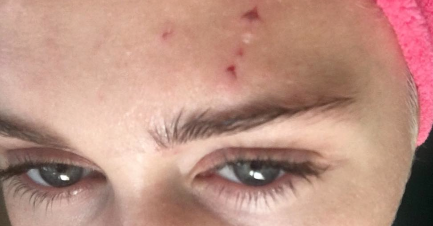 Miley Cyrus Scars Acne Celebrities With Acne: How Do They Face The