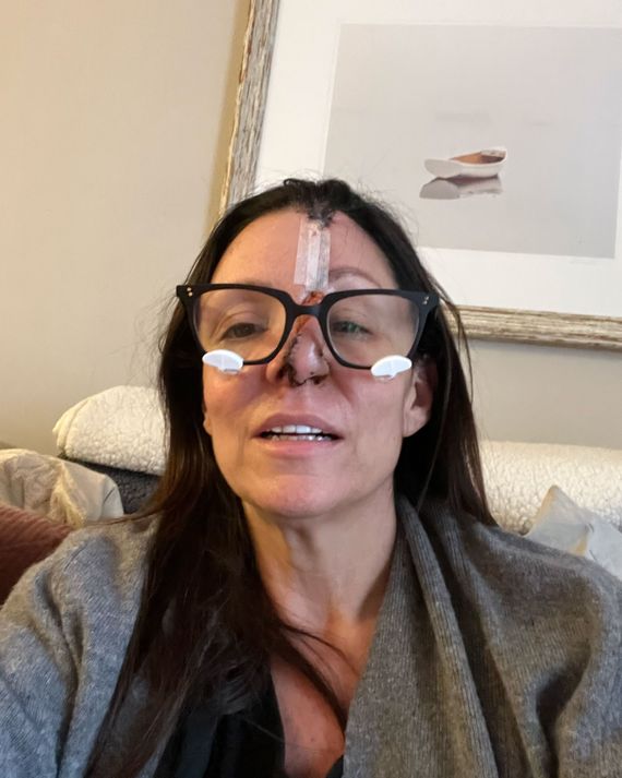 My Journey After Losing My Nose to a Dog Bite