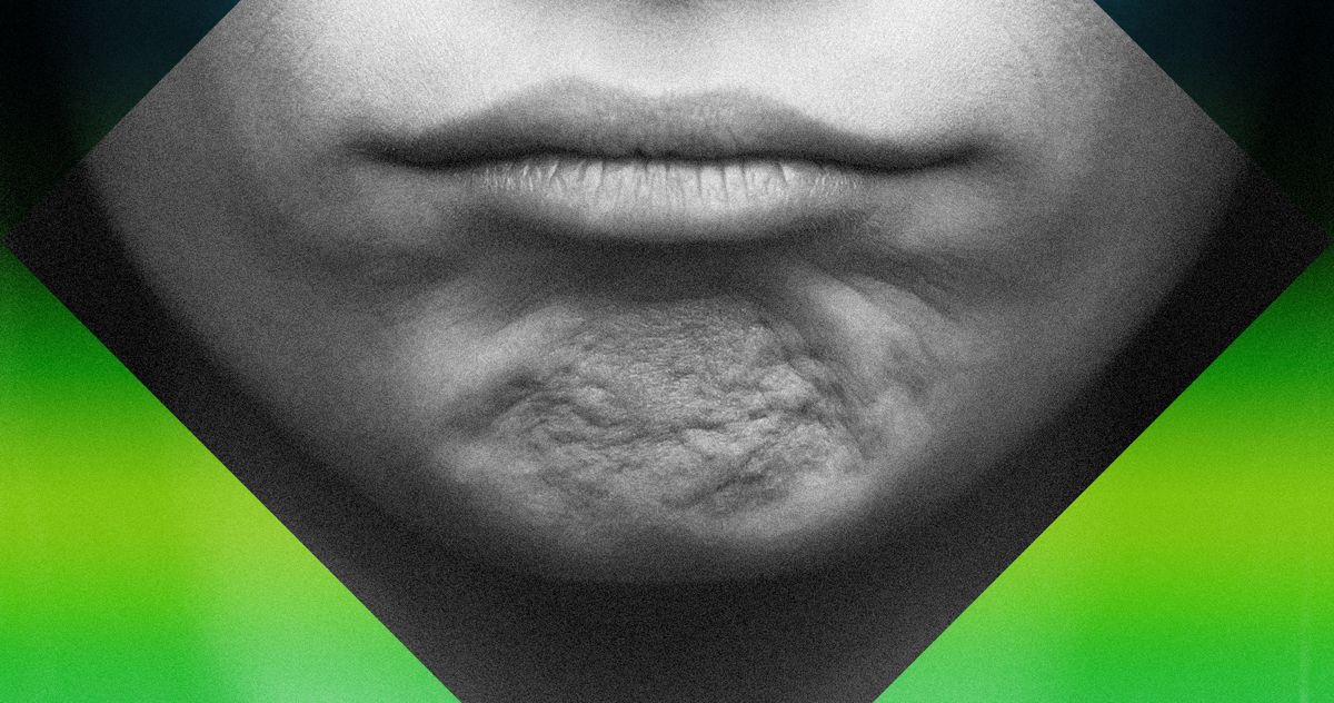 How to Fix Dimply Chin: Surgical and Nonsurgical Options