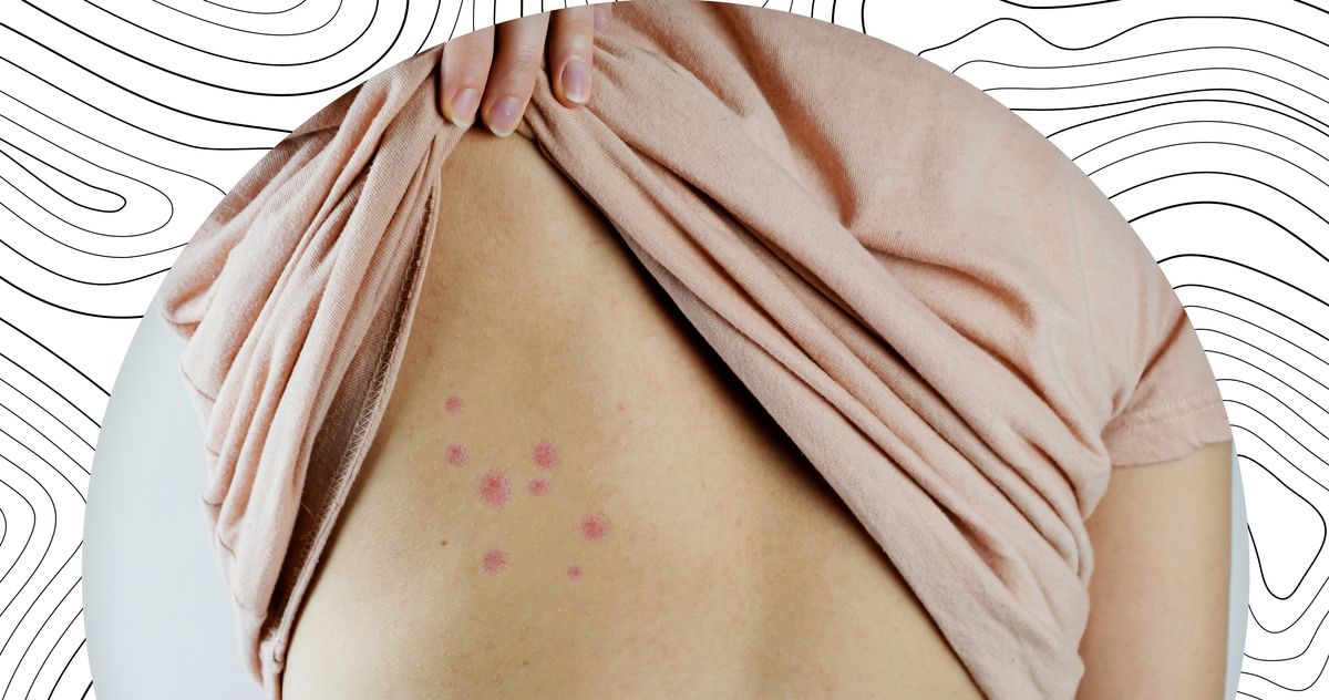 How To Prevent Mosquito and Bug Bites