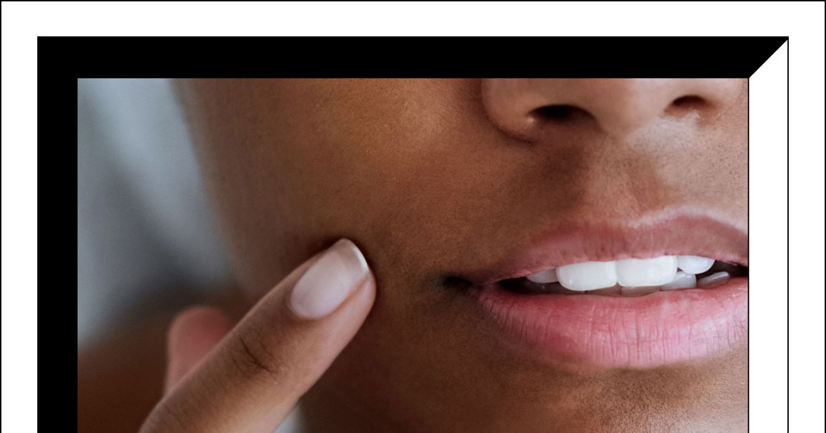What Your Love of Pimple-Popping Videos Says About You