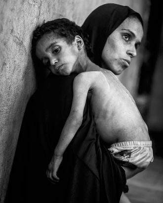 Hunger in Gaza: What Starvation Does to a Child’s Body