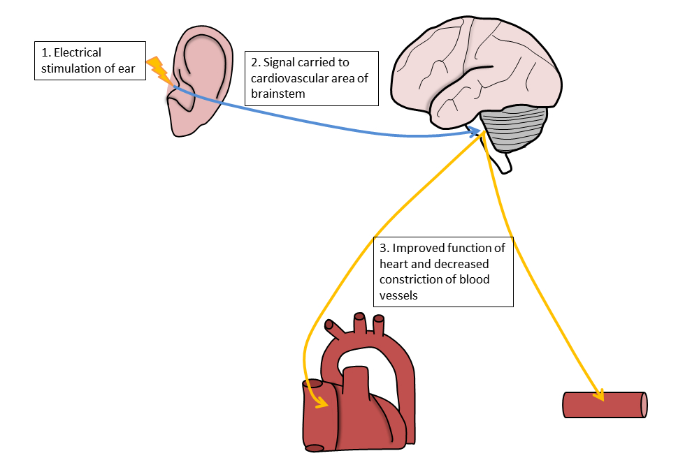 Can This Weird Ear-Tickling Gadget Improve Heart Health?