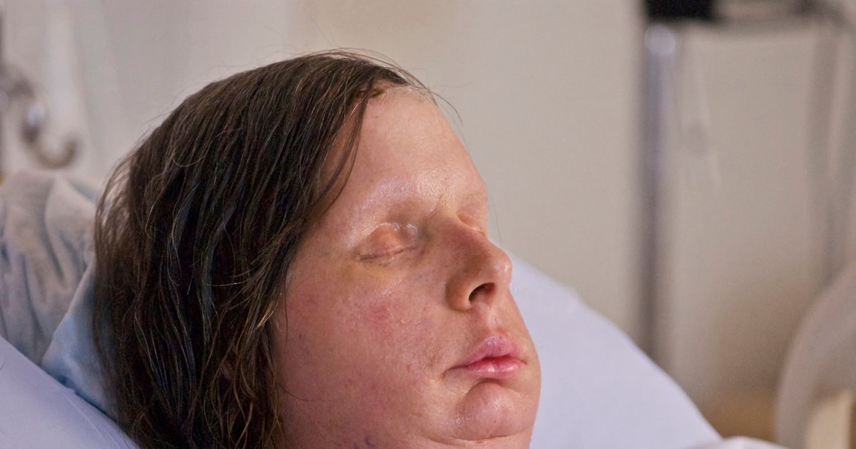 Chimp Attack Face Transplant Is a Success