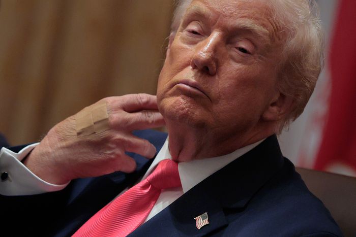 What’s the Deal With Trump’s Hand Bruise and Health Issues?