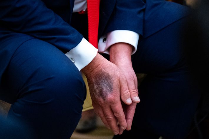 What’s the Deal With Trump’s Hand Bruise and Health Issues?