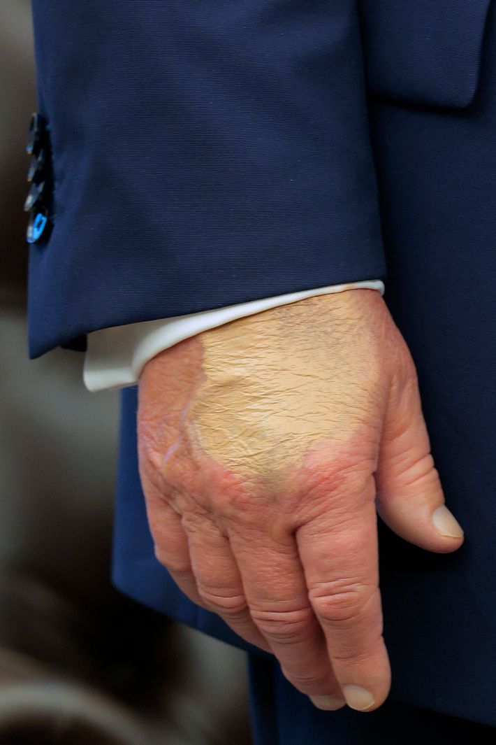 What’s the Deal With Trump’s Hand Bruise and Health Issues?