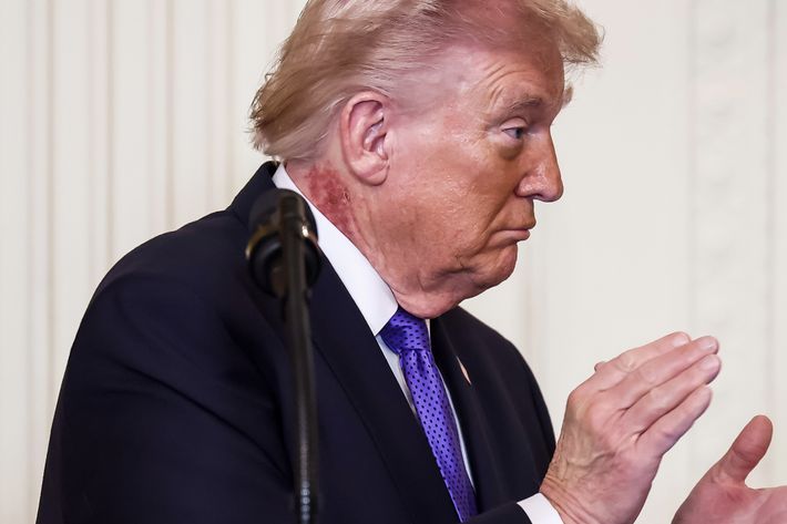 What’s the Deal With Trump’s Hand Bruise and Health Issues?