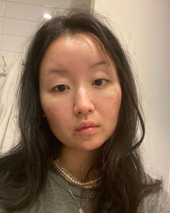 What Is an Accutane Nose Job?