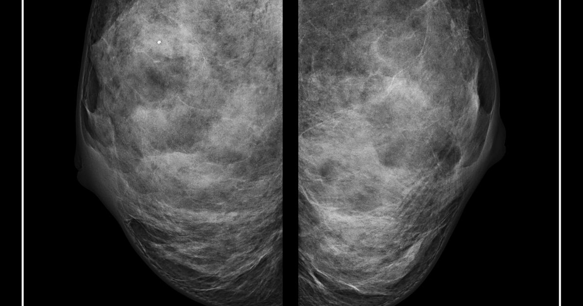 Normal Mammogram Look Like The Normal Breast And Its Variations In