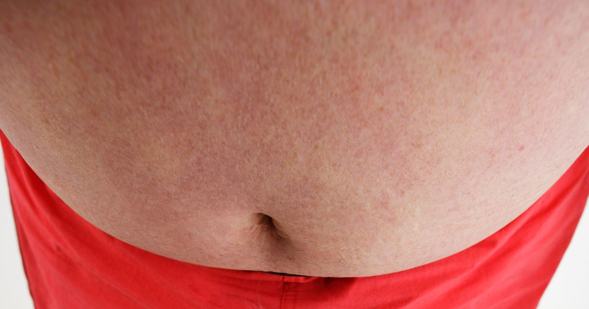 Two Sides of Hurricane Sandy Suffering: Weight Gain vs. Reality