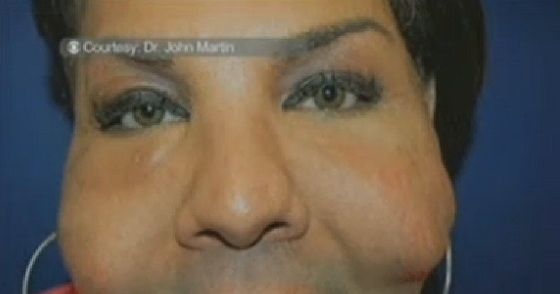 See a Botched Plastic Surgery Victim Whose Face Might Be Filled With Cement